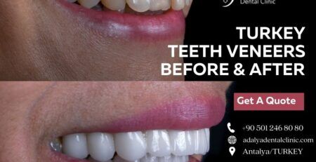 Turkey Teeth Packages 2026: All-Inclusive Dental Packages Turkey