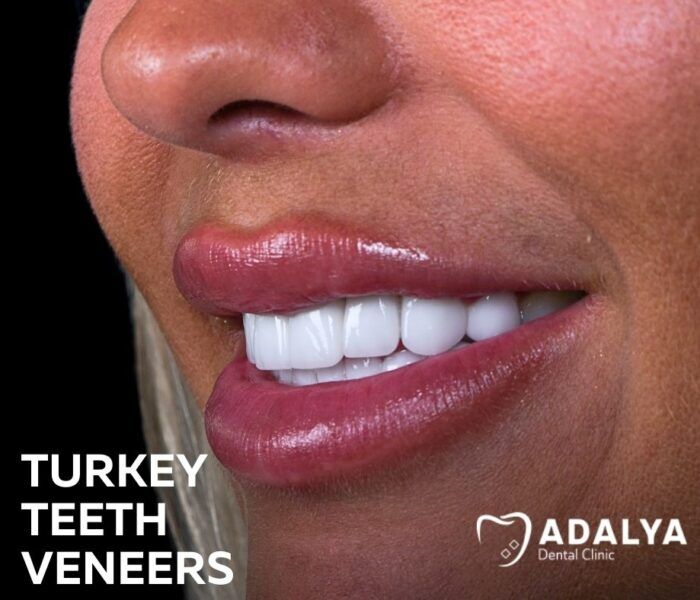 Turkey Teeth Veneers - Affordable Dental Veneer Price in Antalya