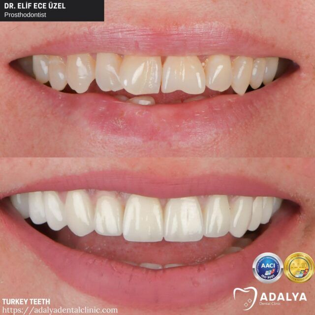 Cost of Turkey Teeth 2026 | Single & Full Set Teeth Prices, Reviews