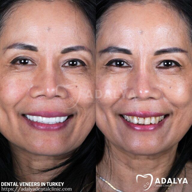 How Much Is A Full Set of Veneers in Turkey?