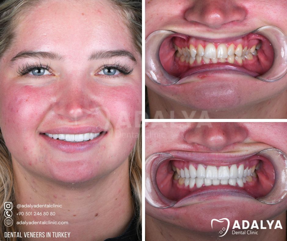 Turkey Teeth Veneers Before and After | Adalya Dental Clinic