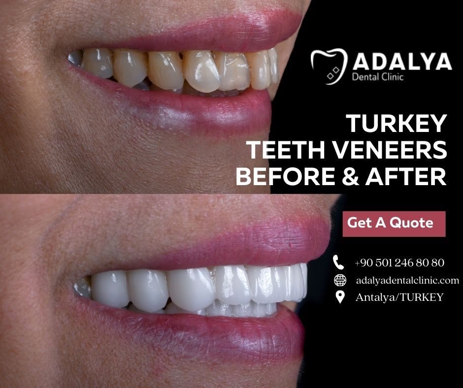 Turkey Teeth Veneers Before and After | Adalya Dental Clinic