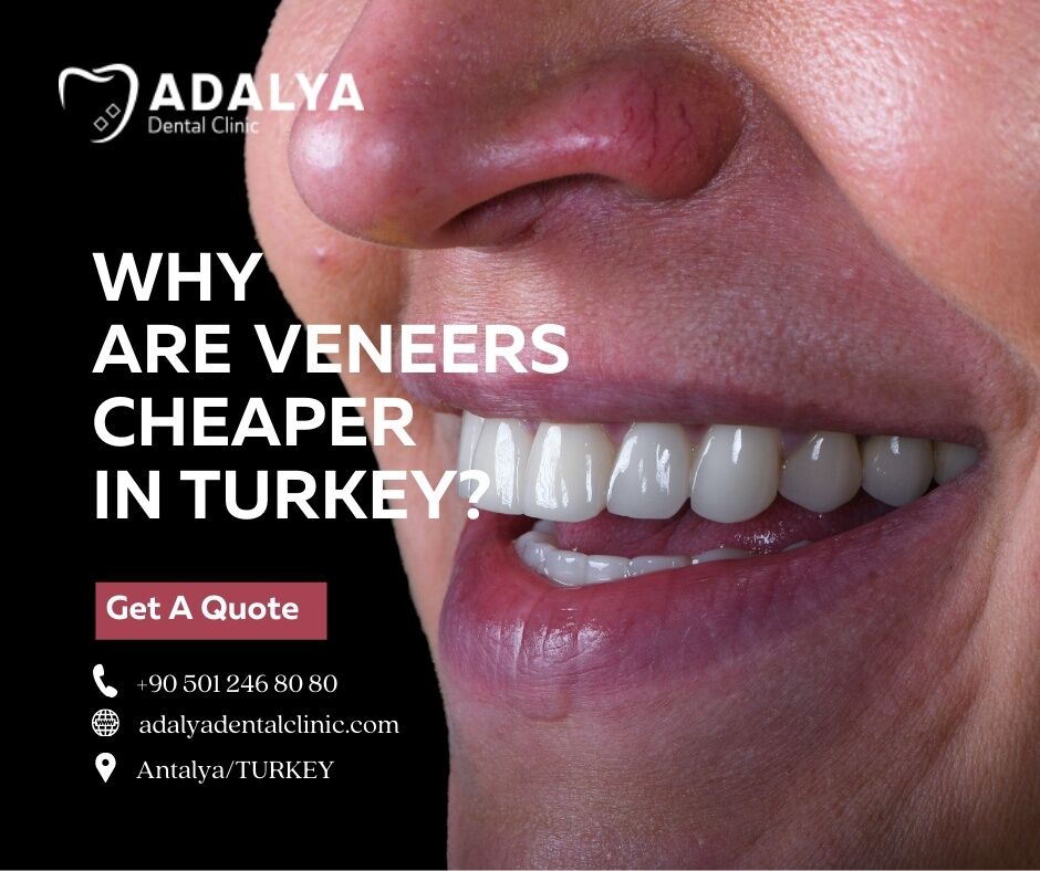 Why Are Veneers Cheaper in Turkey? | Tips to Make You Happy