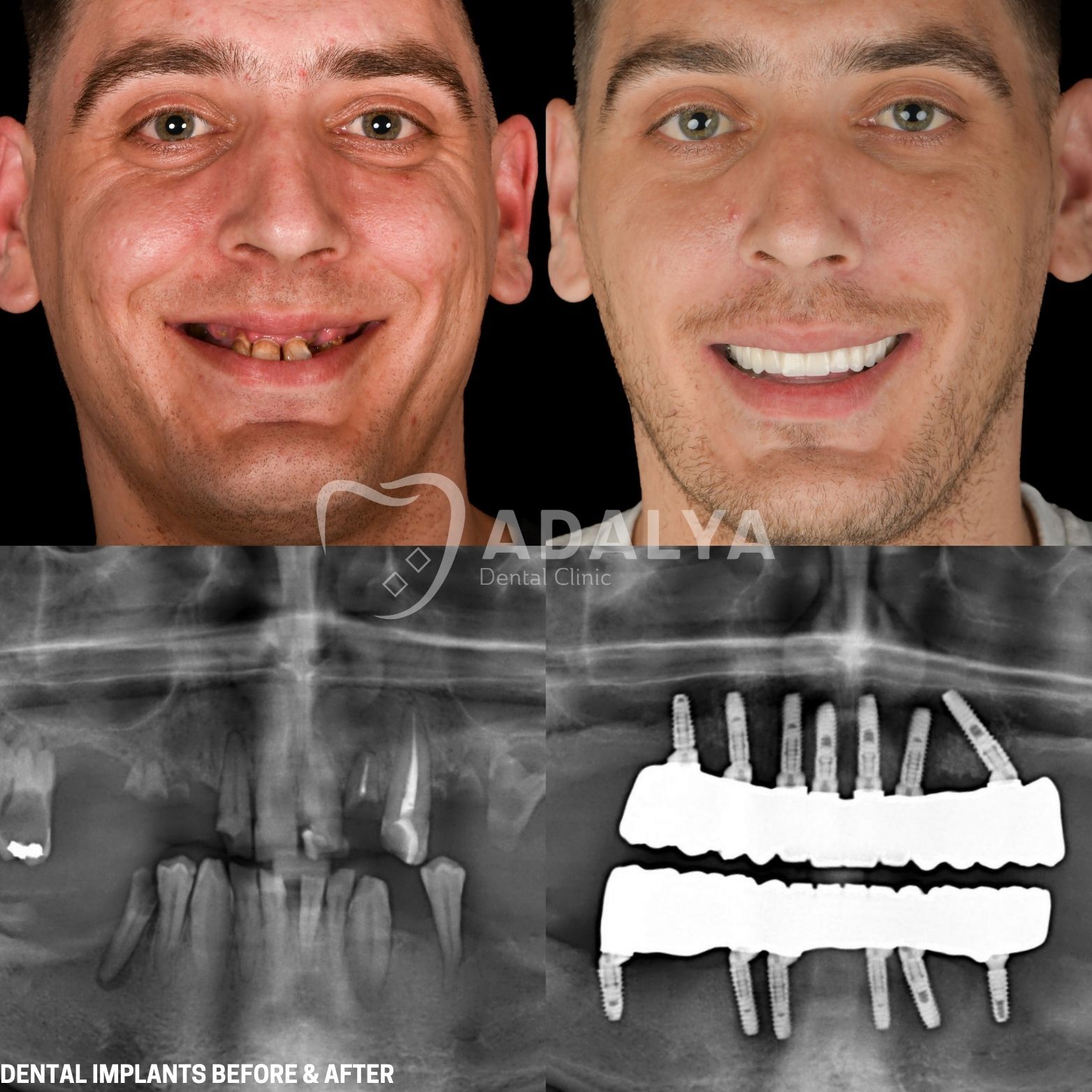 Dental Implants Before and After: Pictures & All Guideline