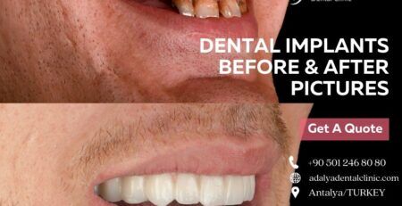 Bone Density For Dental Implants: D1, D2, D3, D4 Bone Qualities