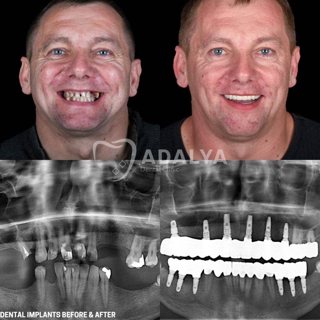 Dental Implants Before and After: Pictures & All Guideline