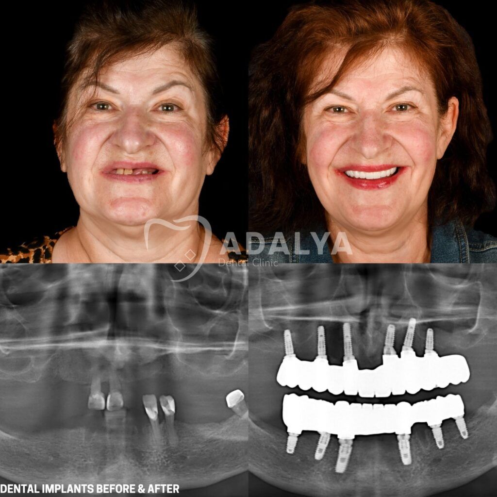 Dental Implants Before and After: Pictures & All Guideline
