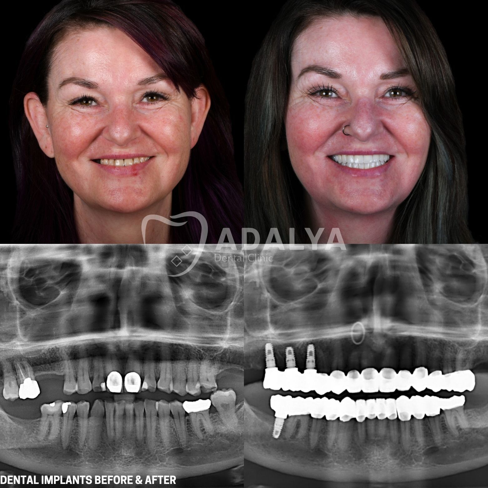 Dental Implants Before and After: Pictures & All Guideline