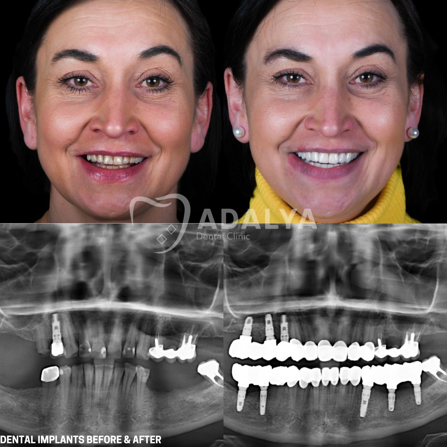 Dental Implants Before and After: Pictures & All Guideline