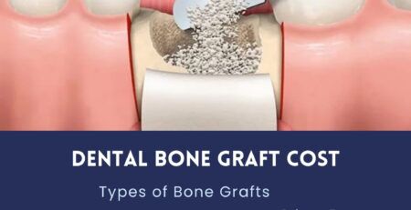 Bone Density For Dental Implants: D1, D2, D3, D4 Bone Qualities