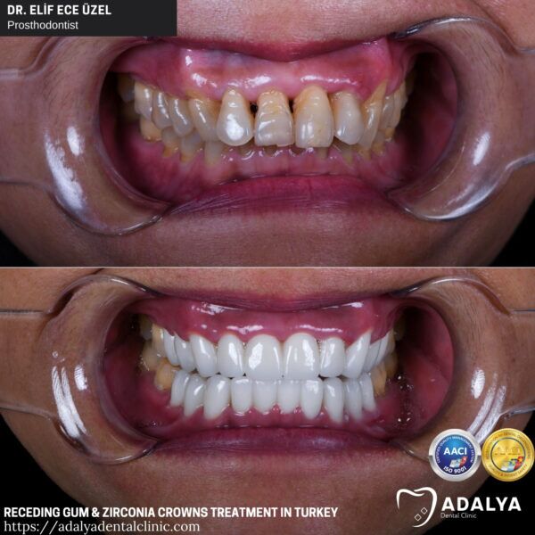Receding Gum Stages - Early Receding Gums Stages | Adalya
