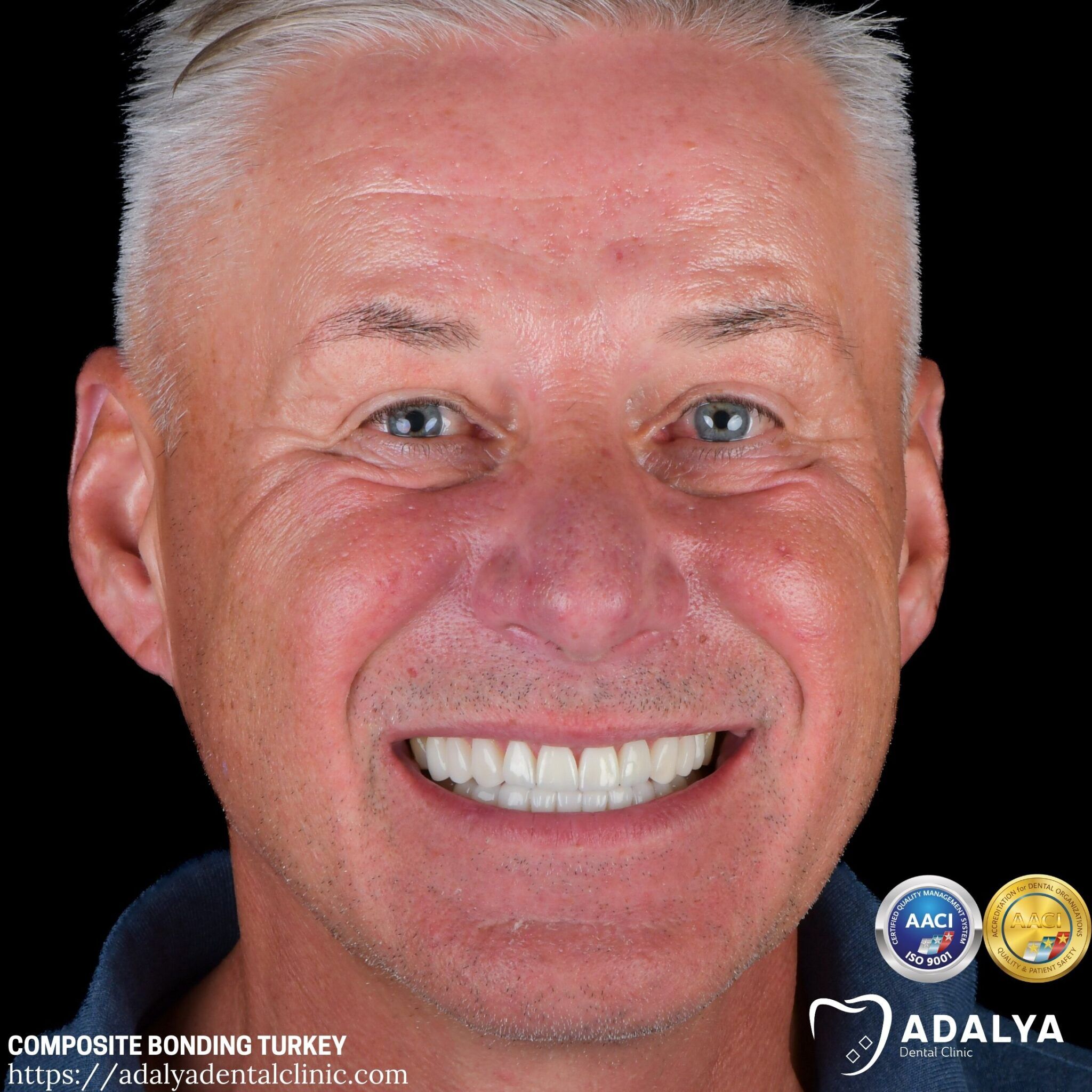 Composite Bonding in Turkey - Cost, Advantages, Price - Antalya Veneers