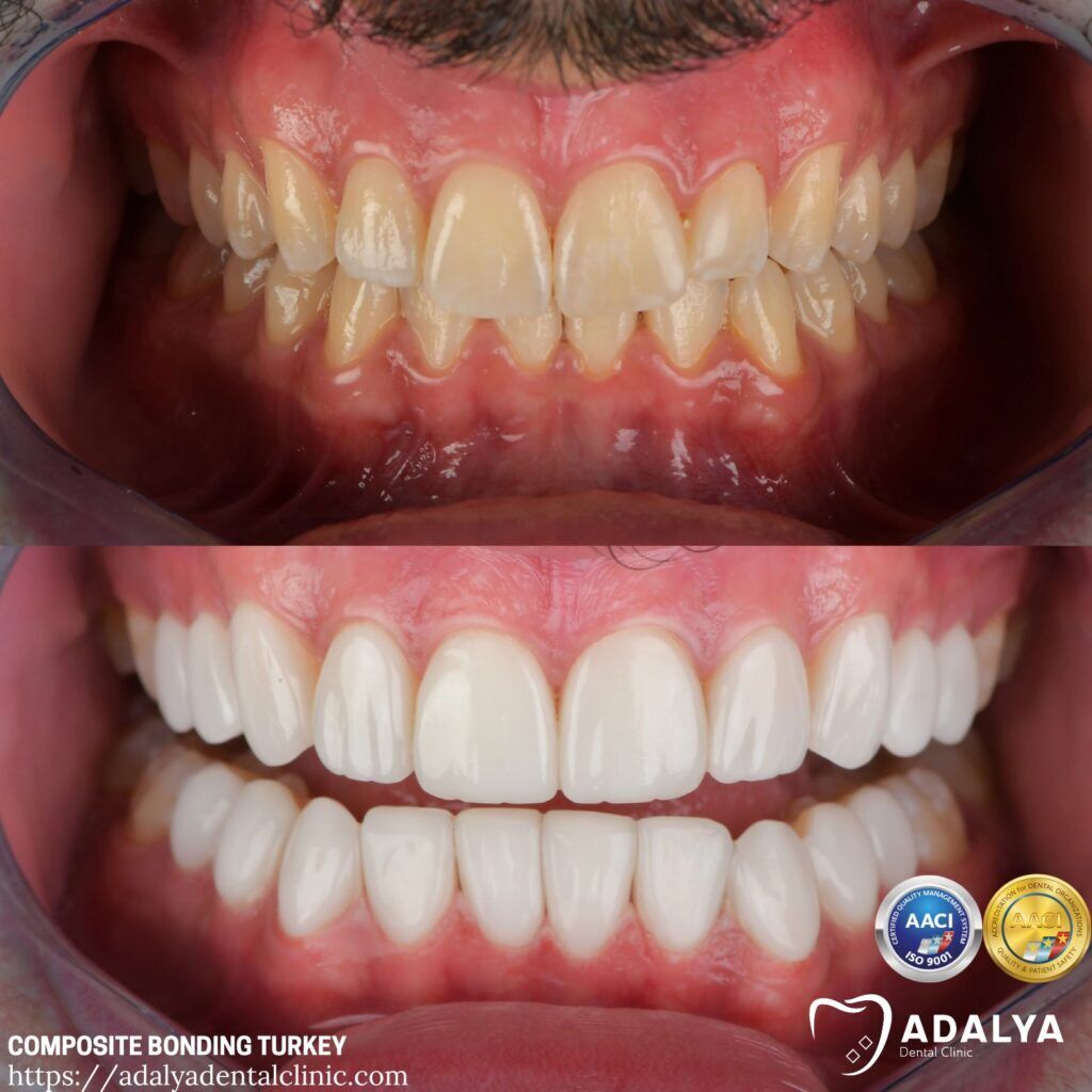 Composite Bonding Turkey: Price 2026, Packages in Antalya