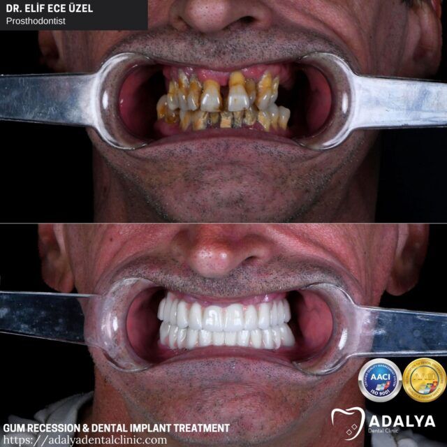 Receding Gum Line Causes - How to Fix Receding Gums