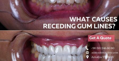 Gum Disease Stages - Periodontal Disease Early Stages | Adalya