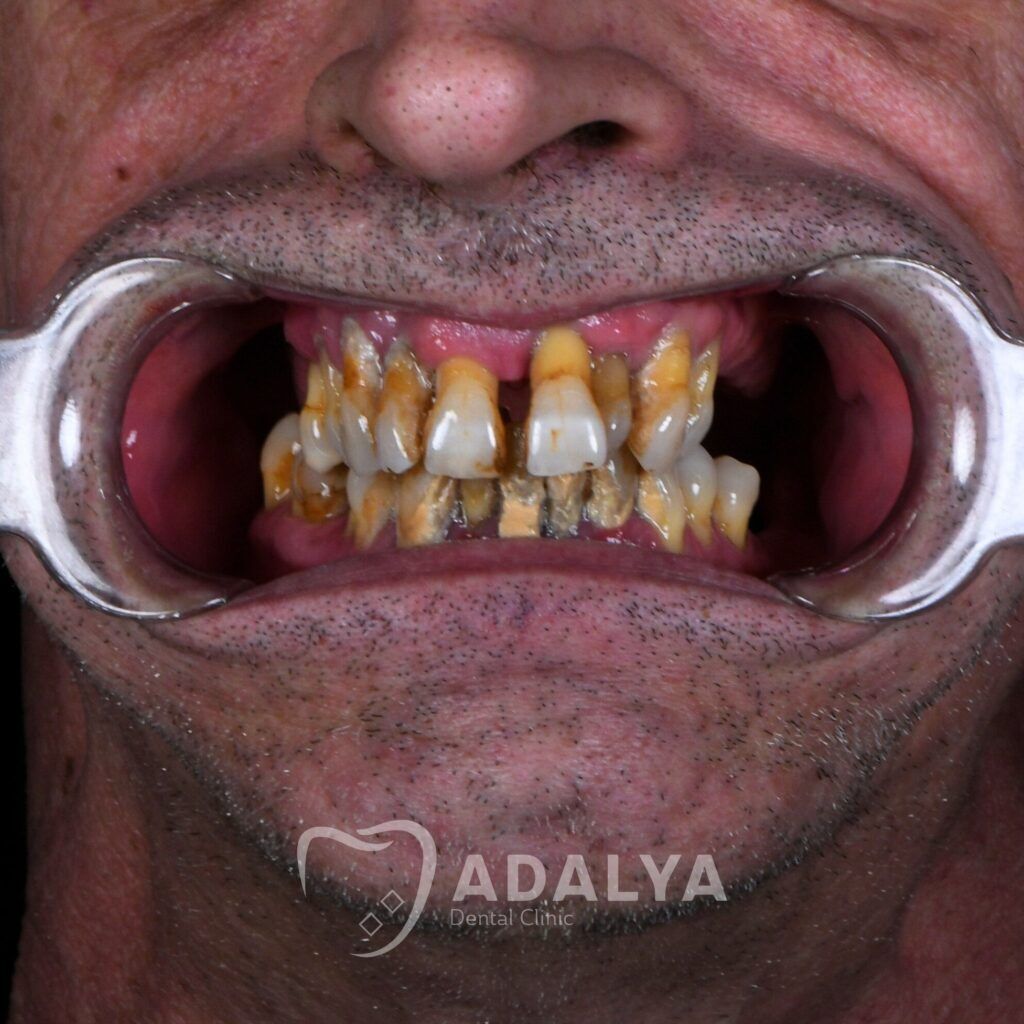 Receding Gum Line Causes - How to Fix Receding Gums