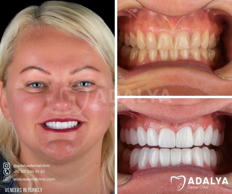 Cost of Veneers in Turkey 2025 | Porcelain Teeth Prices, Reviews