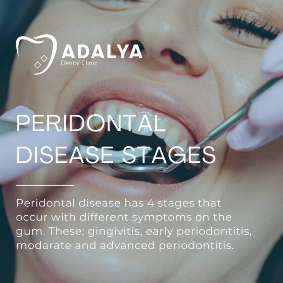 Gum Disease Stages - Periodontal Disease Early Stages | Adalya
