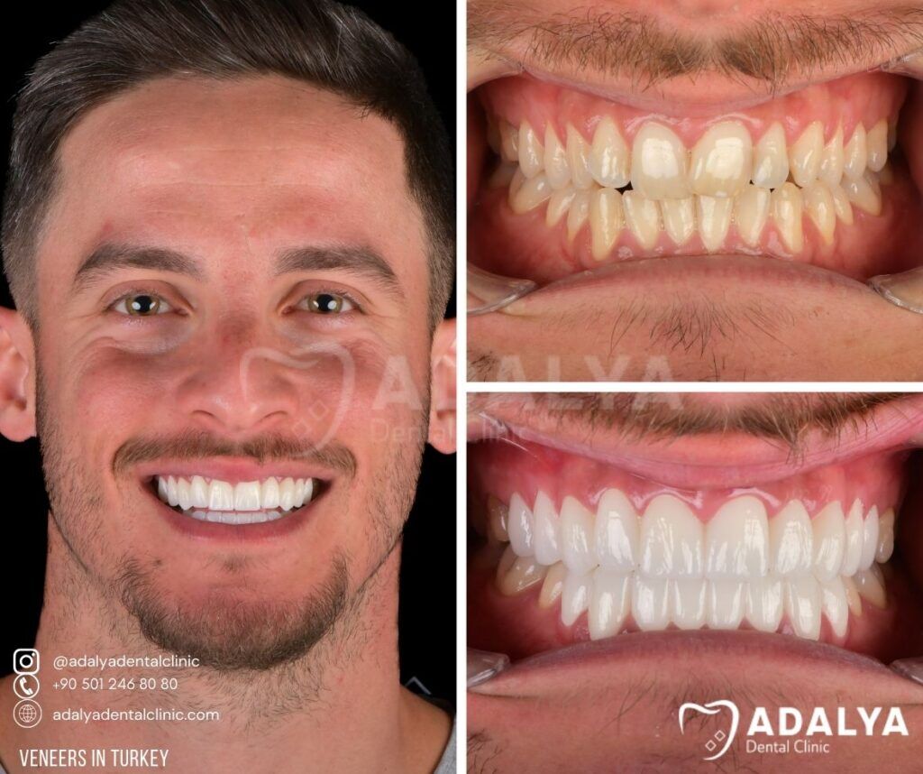 Turkey Teeth Veneers Before and After | Adalya Dental Clinic