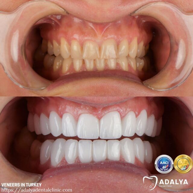 Cost of Veneers in Turkey 2025 | Porcelain Teeth Prices, Reviews