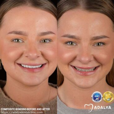 Composite Bonding Before and After - Adalya Dental Clinic