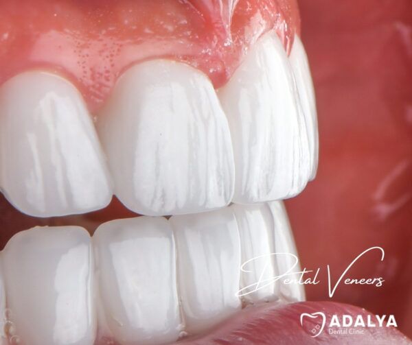 35 Celebrities With Veneers: Before and After Transformations