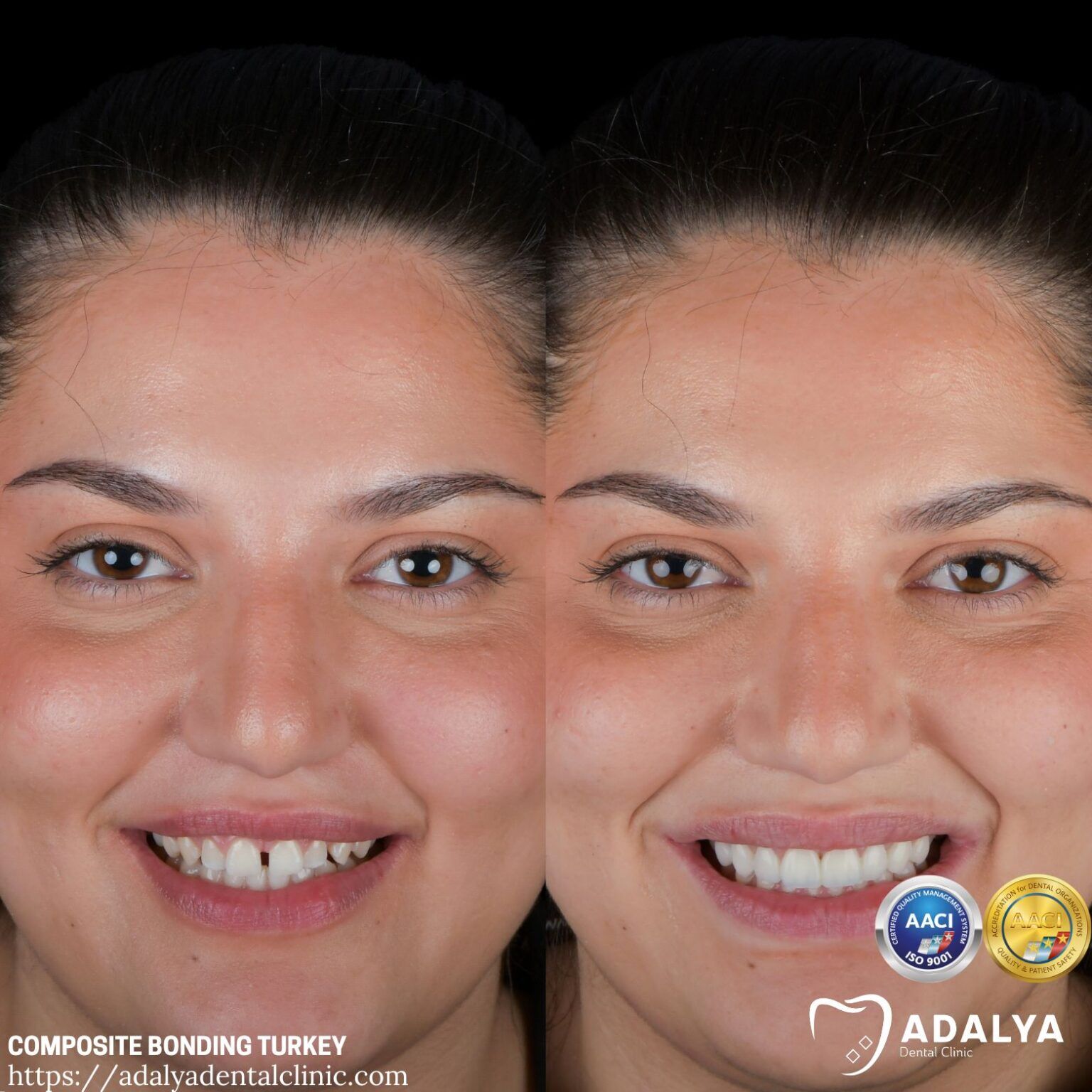 Composite Bonding Before and After - Adalya Dental Clinic