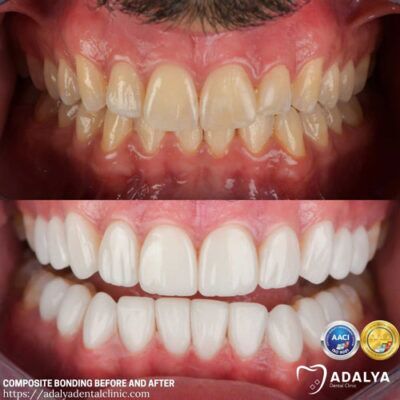 Composite Bonding Before and After - Adalya Dental Clinic