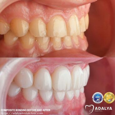 Composite Bonding Before and After - Adalya Dental Clinic