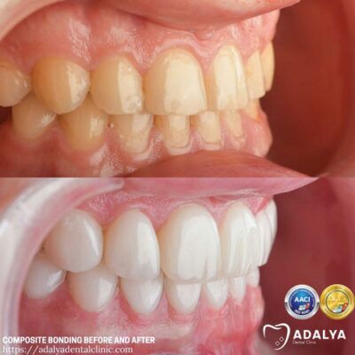 Composite Bonding Before and After - Adalya Dental Clinic