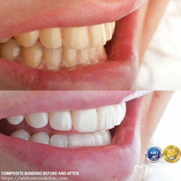 Composite Bonding Before and After - Adalya Dental Clinic