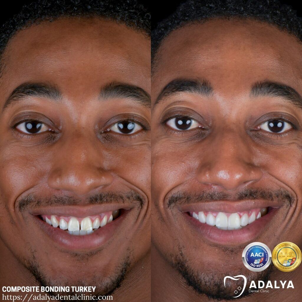 Composite Bonding Before and After - Adalya Dental Clinic