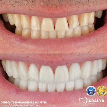Composite Bonding Before and After - Adalya Dental Clinic