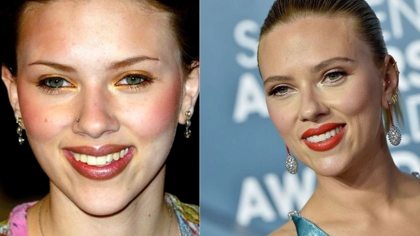 Celebrity Bad Teeth Before After Celebrity Dental Implants And Veneers