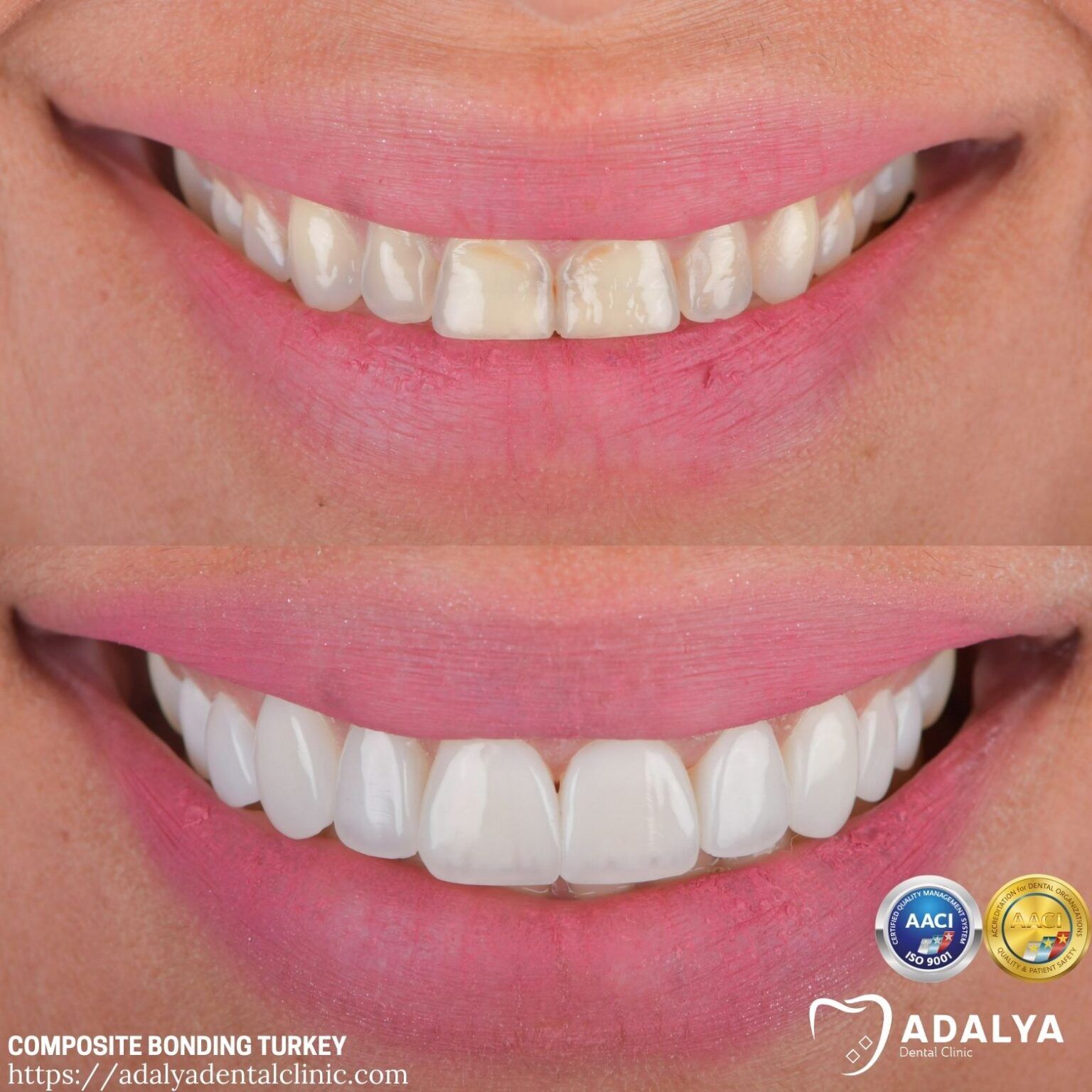 Composite Bonding Before and After - Adalya Dental Clinic