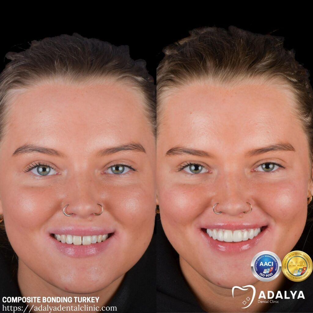 Composite Bonding Before and After - Adalya Dental Clinic