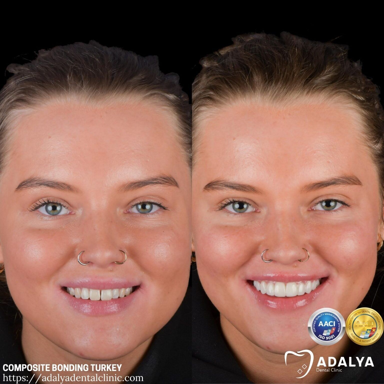 Composite Bonding Before and After - Adalya Dental Clinic