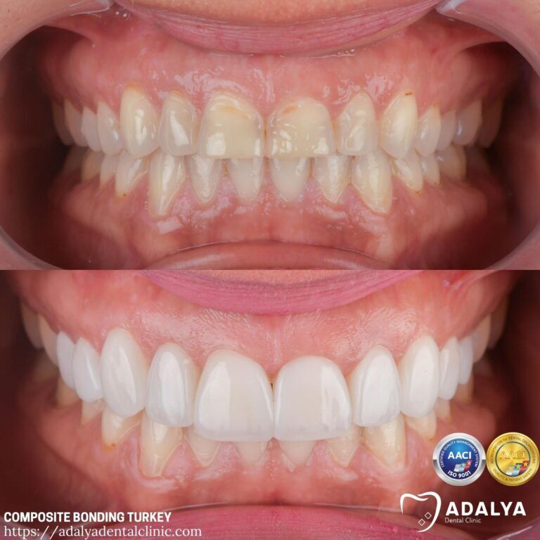 Composite Bonding Before and After - Adalya Dental Clinic
