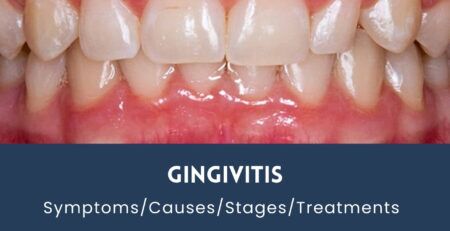 Receding Gum Stages - Early Receding Gums Stages | Adalya