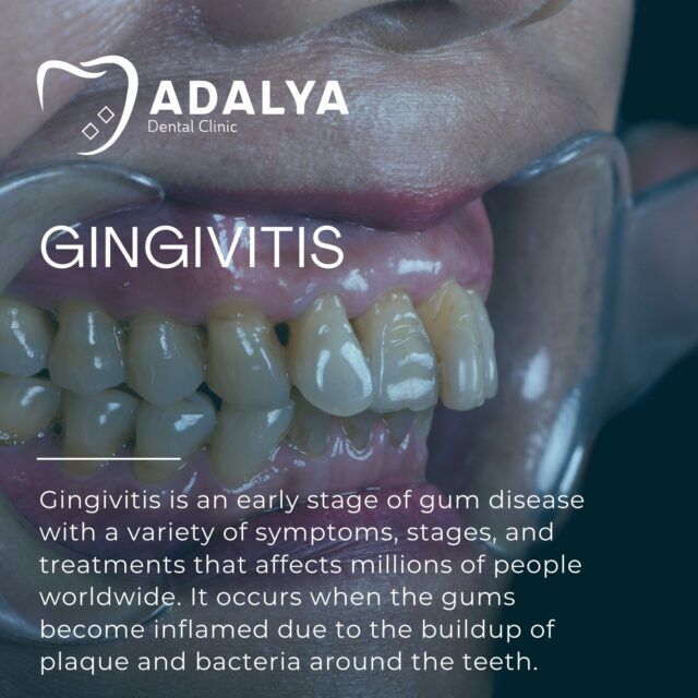 Gingivitis: Symptoms, Causes, Treatment | Adalya Dental Clinic