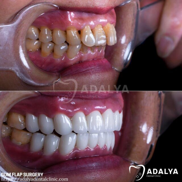 Gum Graft One Week Later: Bleeding? Pain? Swelling? | Adalya