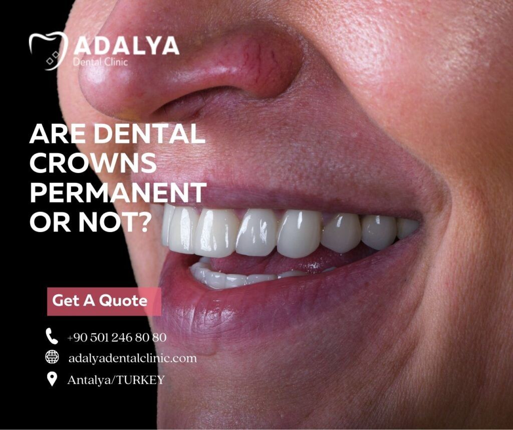 Are Dental Crowns Permanent? - Adalya Dental Clinic