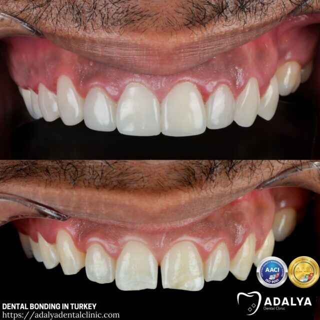 Does Composite Bonding Hurt? - Sensitivity, Pain? | Adalya