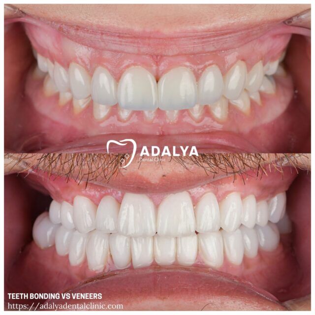 Composite Bonding vs Veneers: Key Differences For Teeth