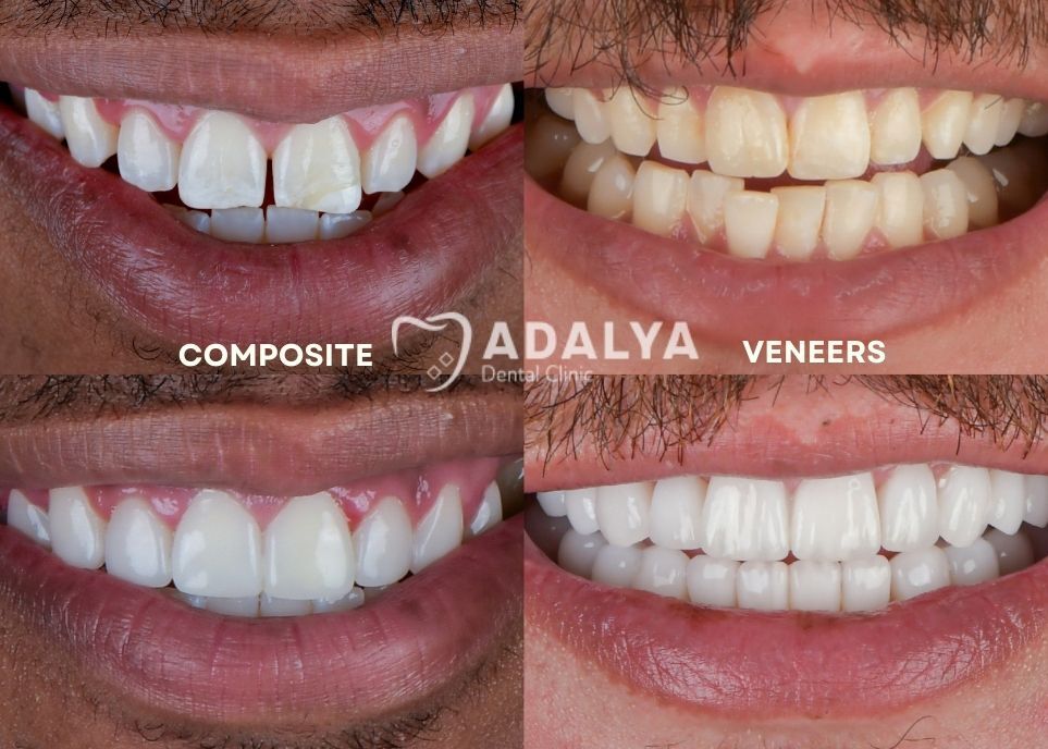 Composite Bonding vs Veneers: Key Differences For Teeth