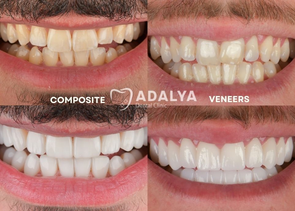 Composite Bonding vs Veneers: Key Differences For Teeth