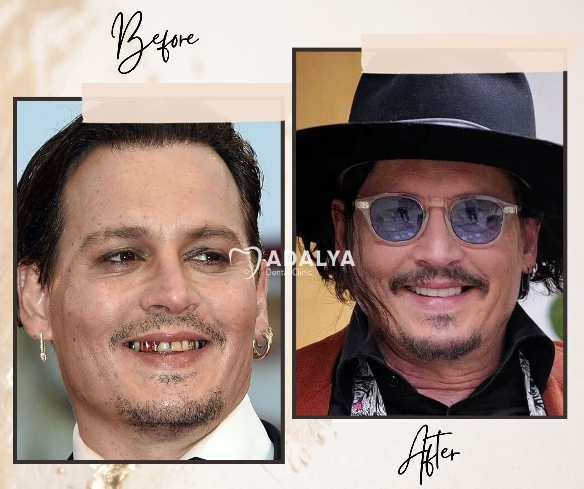 Johnny Depp Teeth: New, Rotting, Before & After Teeth Journey