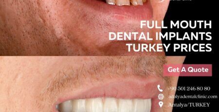 Knochendichte für Zahnimplantate: D1, D2, D3, D4 Knochenqualitäten