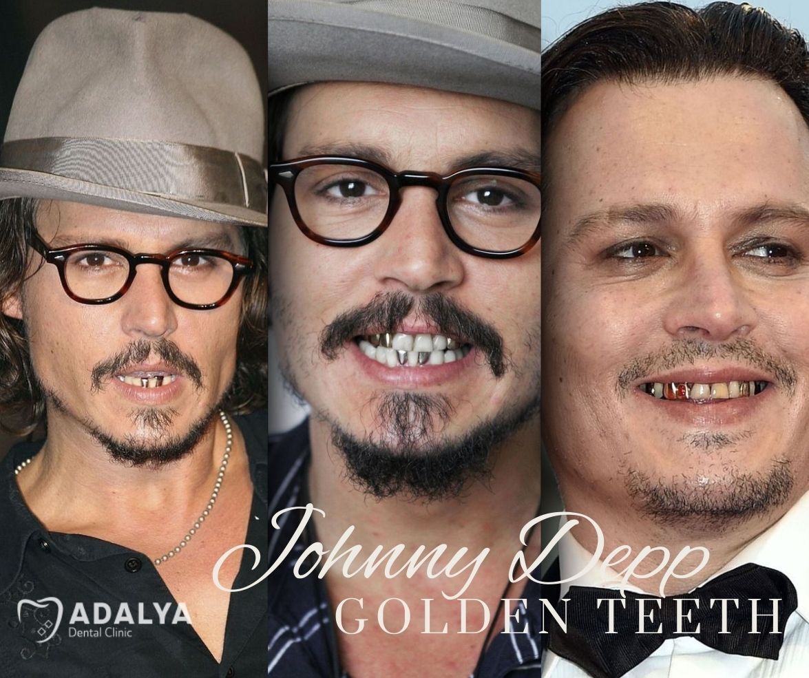 Johnny Depp Teeth: New, Rotting, Before & After Teeth Journey