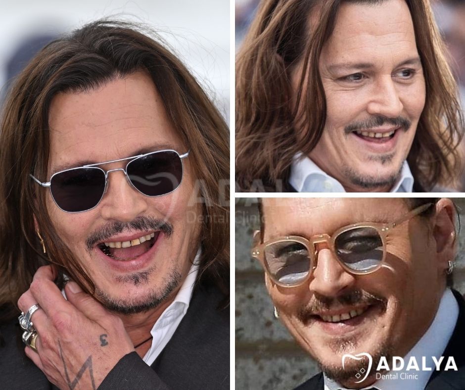 Johnny Depp Teeth: New, Rotting, Before & After Teeth Journey